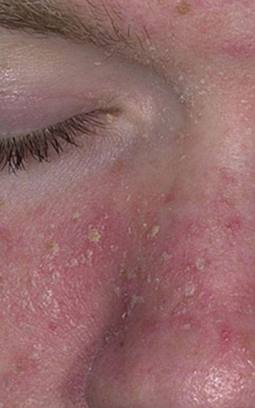 Seborrheic Dermatitis - Revitalis