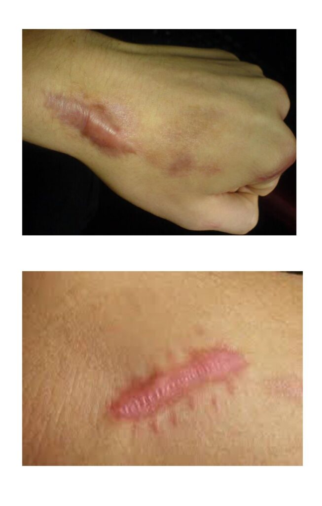 Conquering Keloids: Dermatological Insights and Solutions - Revitalis